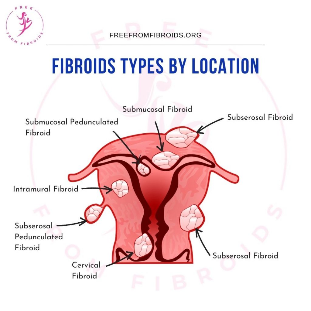Uterine Fibroids Overview - Free From Fibroid Foundation FFF